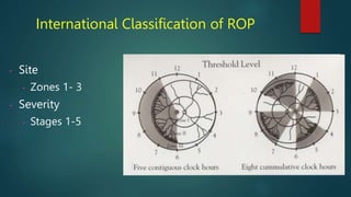 Retinopathy of prematurity for medical students.pptx