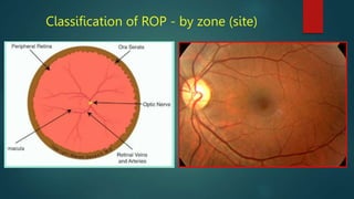 Retinopathy of prematurity for medical students.pptx
