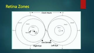 Retinopathy of prematurity for medical students.pptx