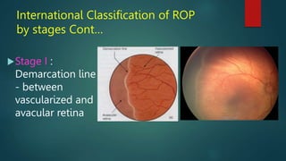 Retinopathy of prematurity for medical students.pptx