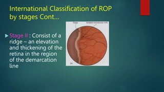 Retinopathy of prematurity for medical students.pptx