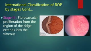 Retinopathy of prematurity for medical students.pptx
