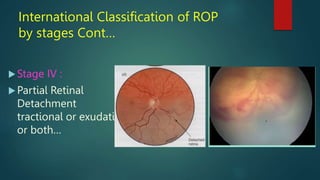 Retinopathy of prematurity for medical students.pptx