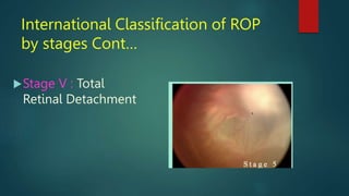 Retinopathy of prematurity for medical students.pptx