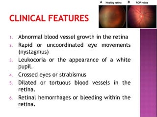 Retinopathy of prematurity.pdf ROP newborn | PDF