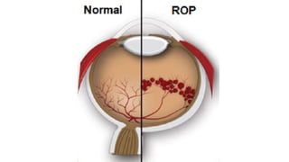 retinopathy of prematurity/ ROP .pptx | Pregnancy | Reproductive Health
