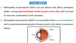 retinopathy of prematurity / ROP .pptx