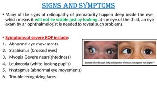 retinopathy of prematurity / ROP .pptx