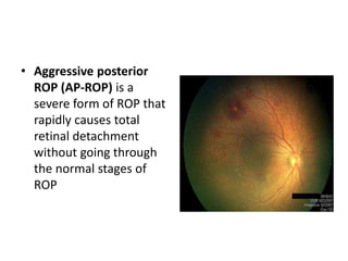 Retinopathy of prematurity by dr. tareq rahman | PPTX