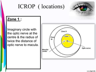 Retinopathy of prematurity by dr sonali paradhi mhatre | PPSX
