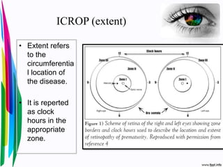 Retinopathy of prematurity by dr sonali paradhi mhatre | PPSX
