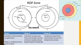 Retinopathy of Prematurity (ROP).pptx slides | PPTX