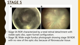 Retinopathy of Prematurity (ROP).pptx slides | PPTX