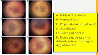 Retinopathy of Prematurity (ROP).pptx slides | PPTX