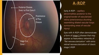 Retinopathy of Prematurity (ROP).pptx slides | PPTX