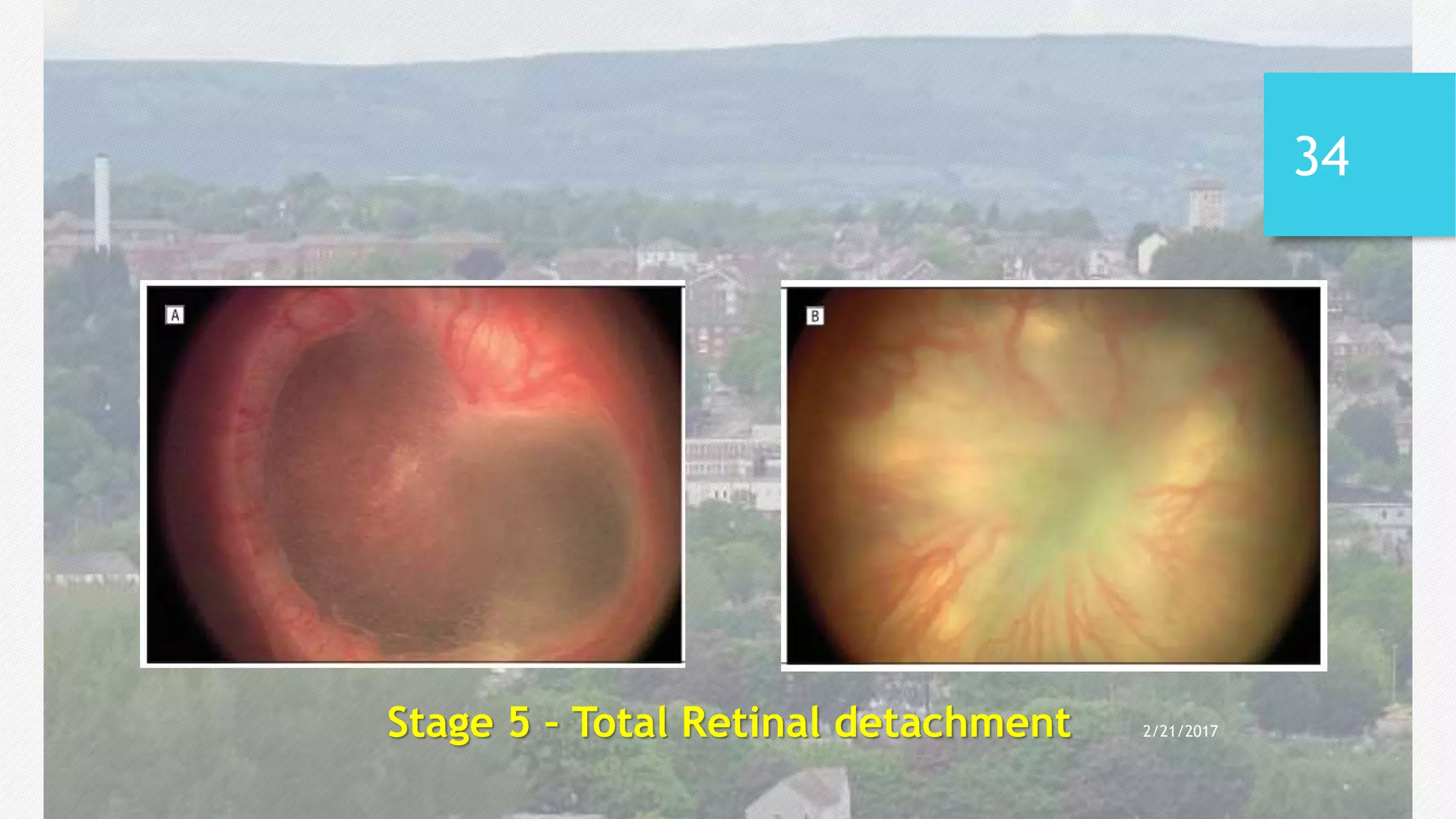 Retinopathy of prematurity rop satish 1 | PPT