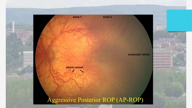 Retinopathy of prematurity rop satish 1 | PPT