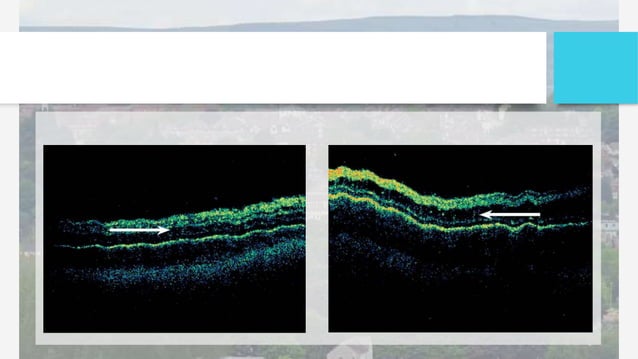 Retinopathy of prematurity rop satish 1 | PPT