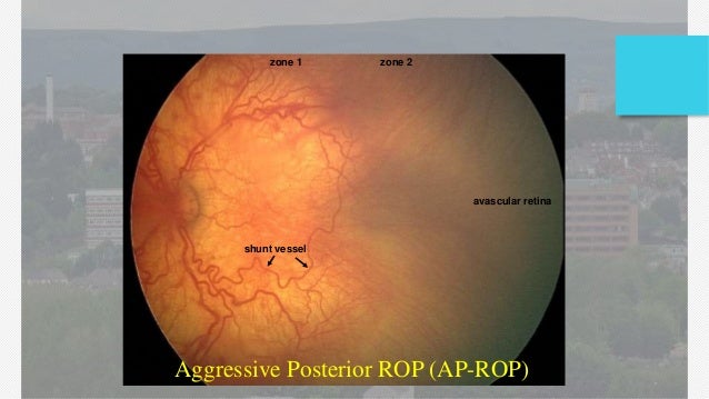 Retinopathy of prematurity rop satish 1