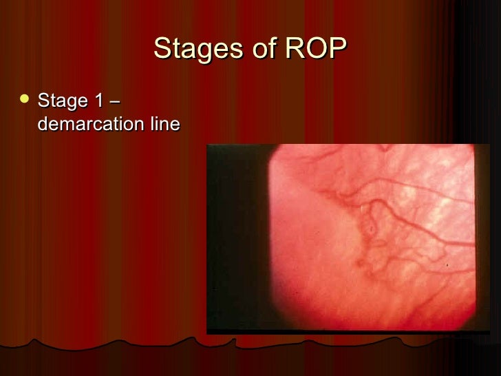 Retinopathy of prematurity (upload for site)