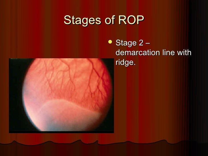 Retinopathy of prematurity (upload for site)