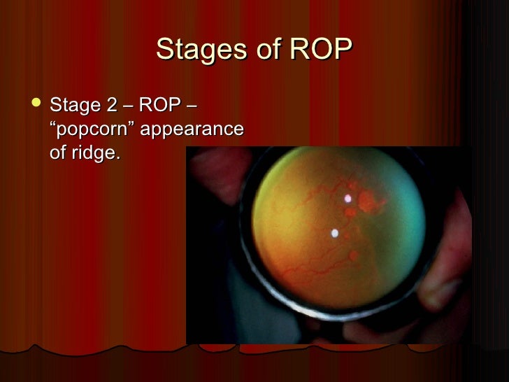 Retinopathy of prematurity (upload for site)