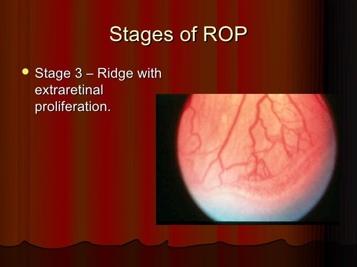 Retinopathy of prematurity (upload for site)
