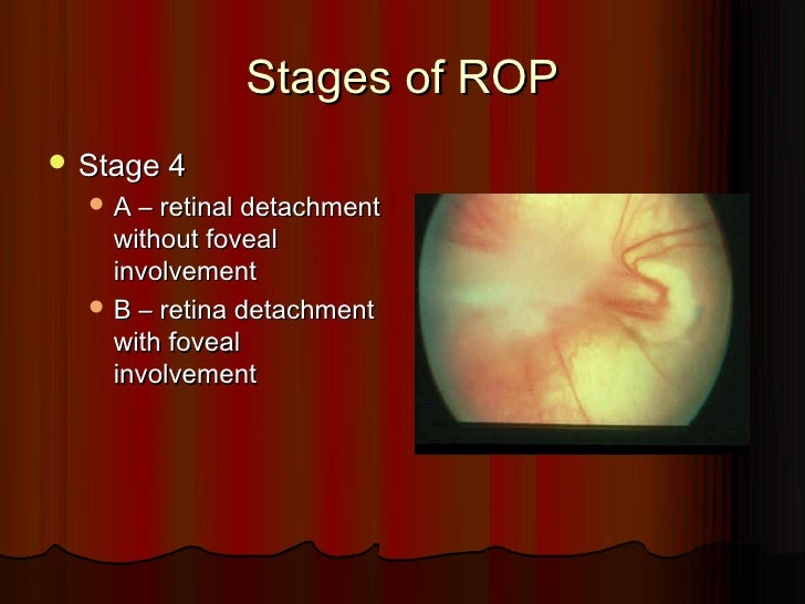 Retinopathy of prematurity (upload for site)