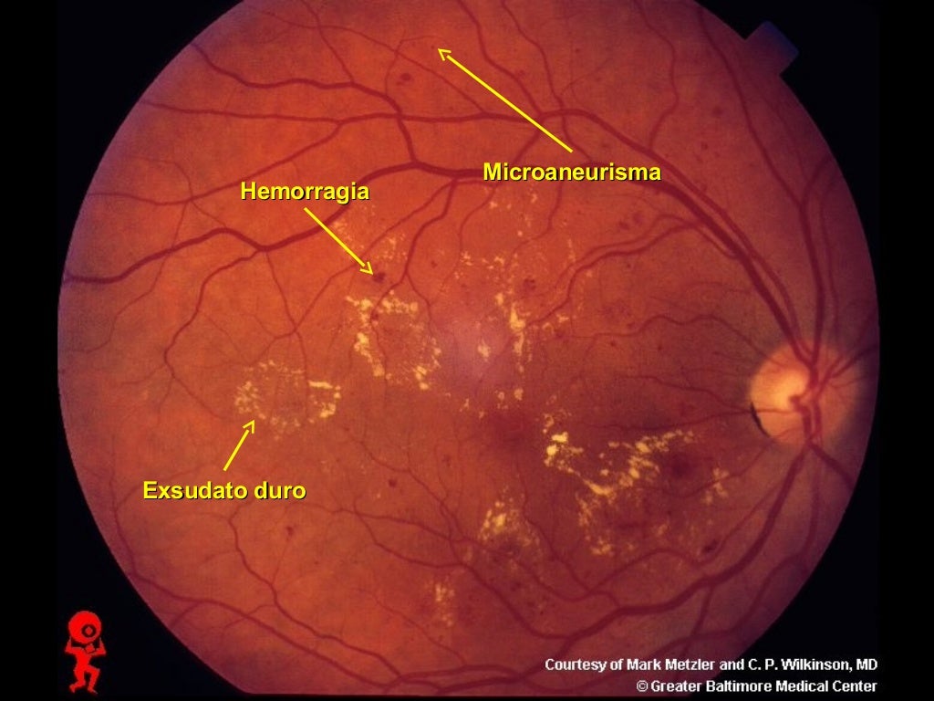 Retinopatia diabética