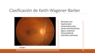 Retinopatia hipertensiva Retina.pptx