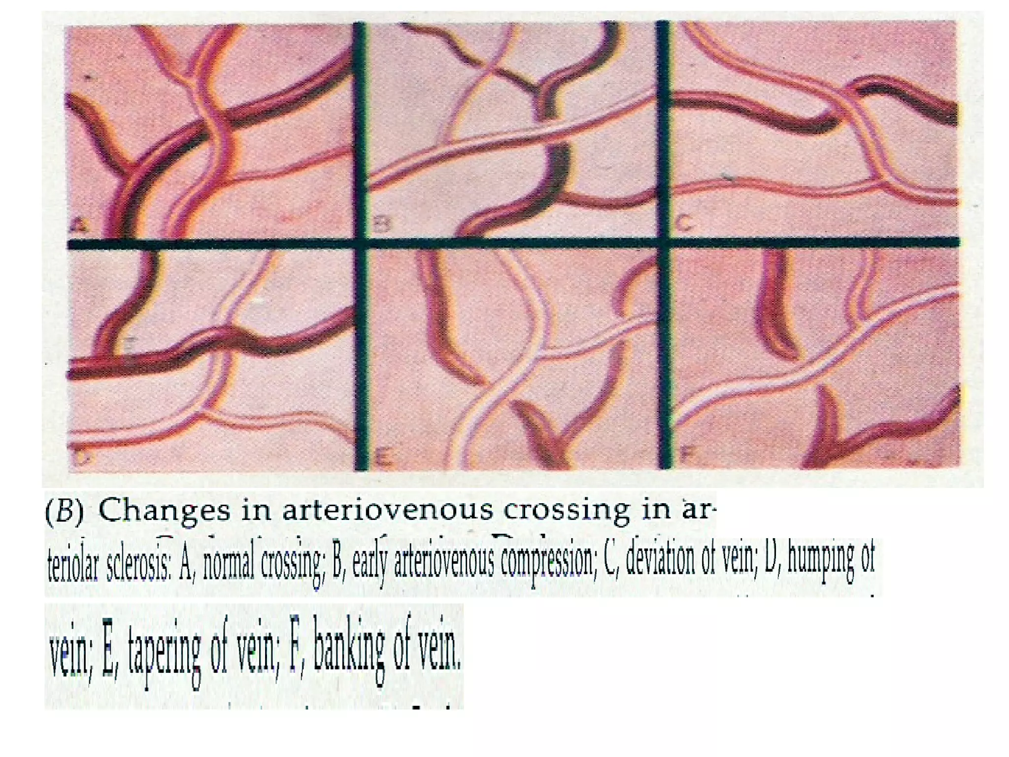 Retinopati hipertensi | PPT
