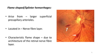 Diabetic Retinopathy | PPTX