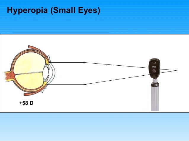 retinoscopy
