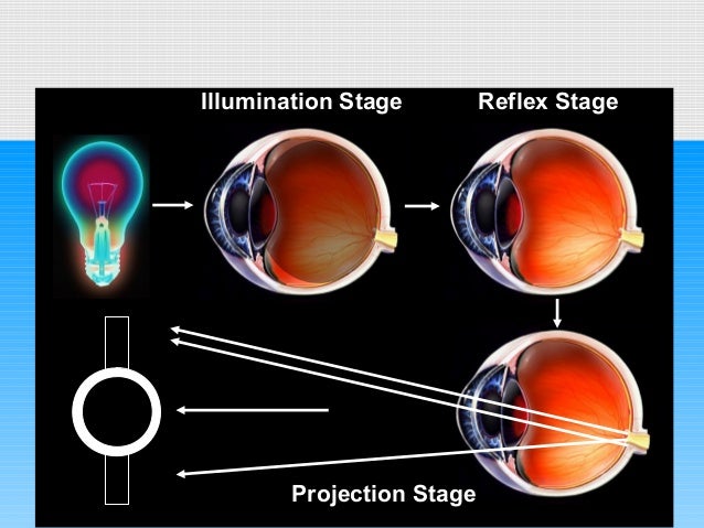 retinoscopy