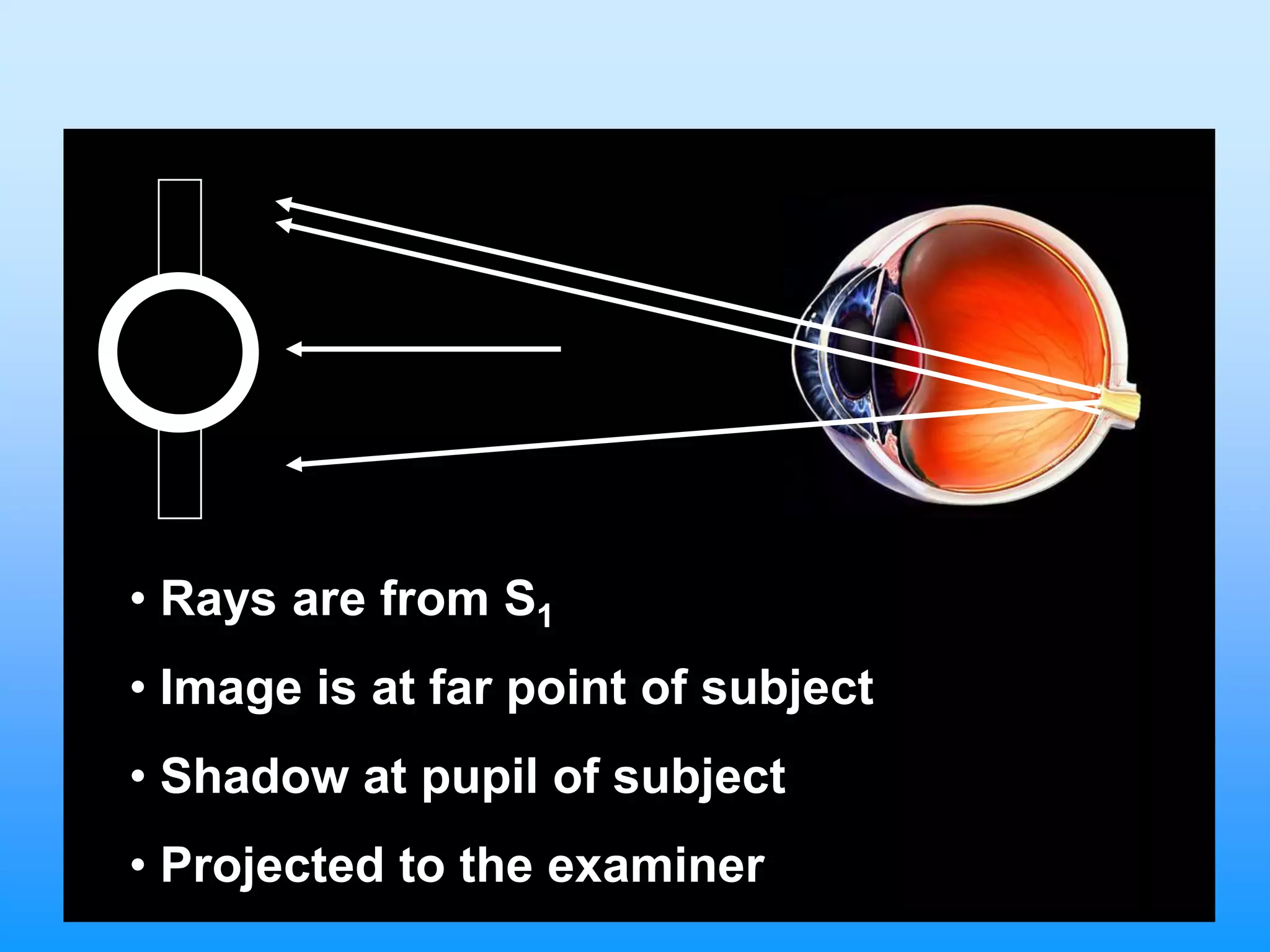 Refraction and Retinoscopy | PPT