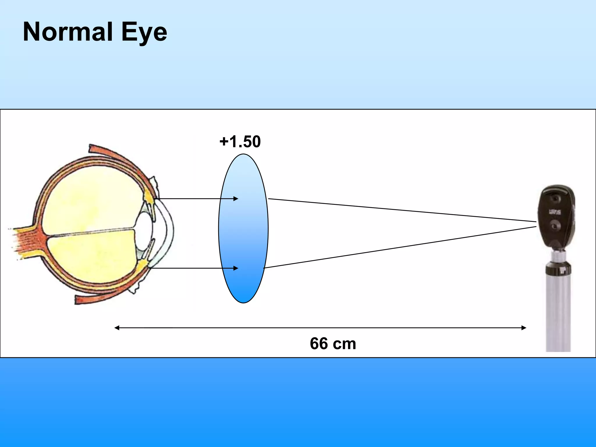 Refraction and Retinoscopy | PPT