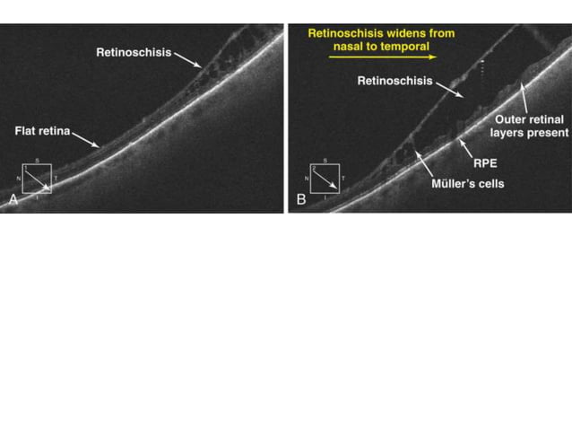 Retinoschisis | PPTX