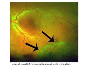 Retinoschisis | PPTX