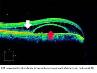Retinoschisis | PPT