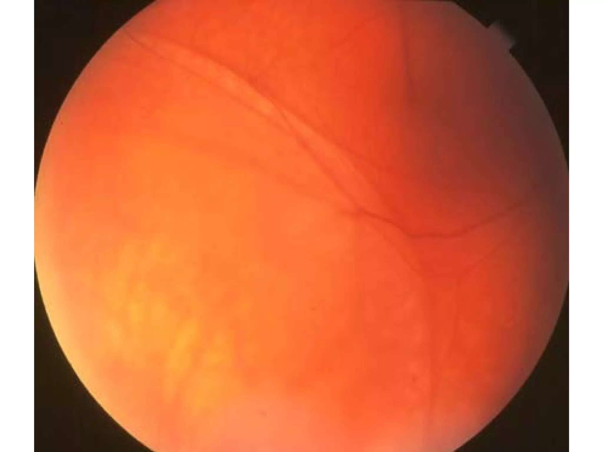 Retinoschisis | PPT