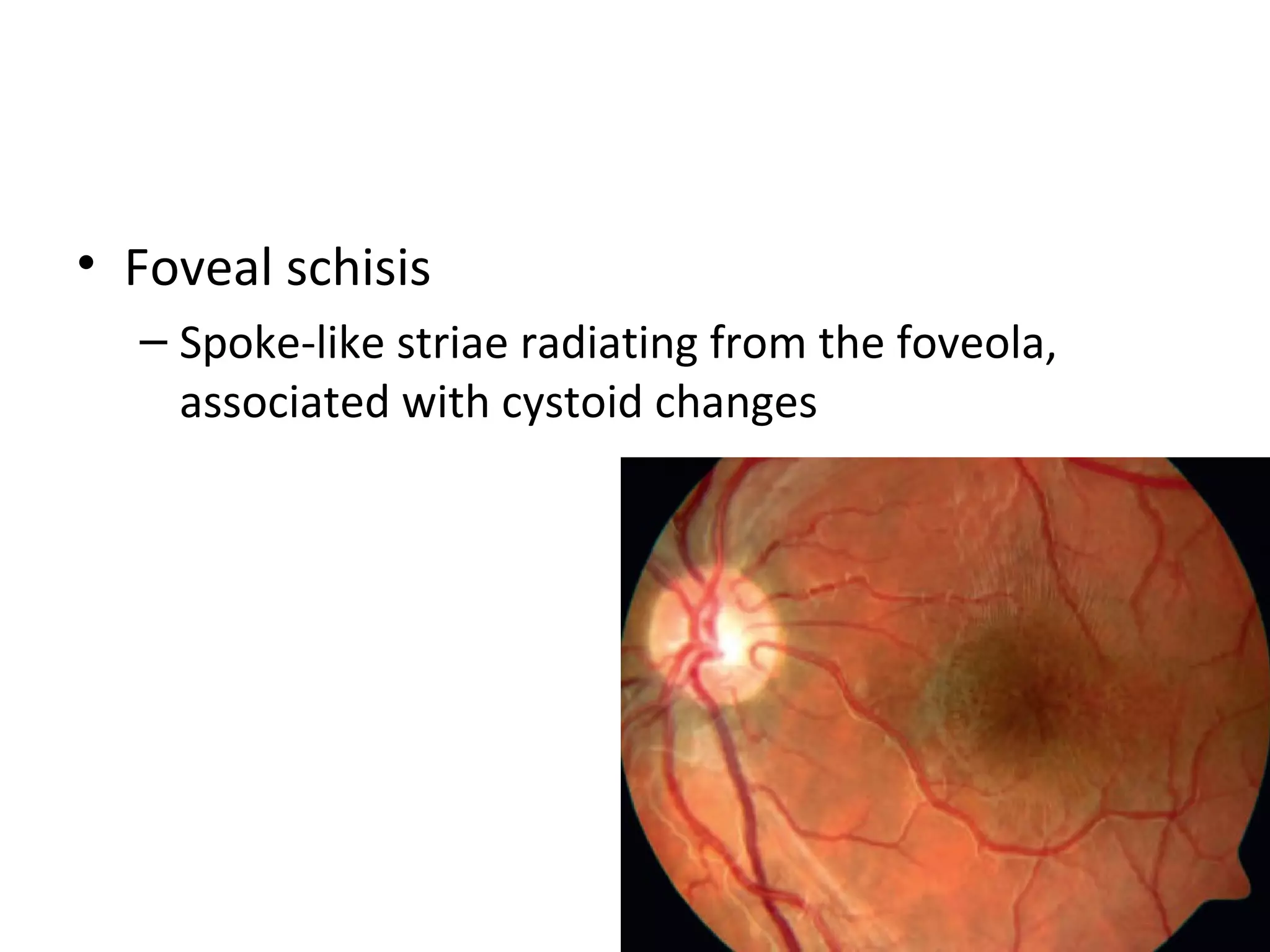 Retinoschisis | PPT