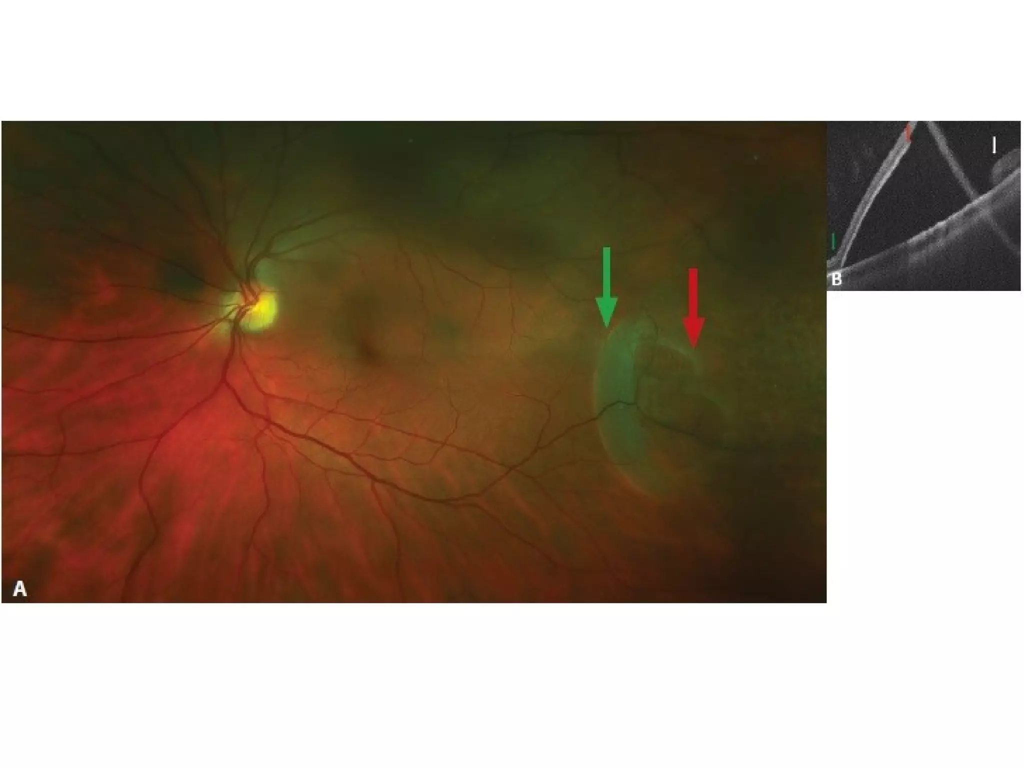 Retinoschisis | PPT