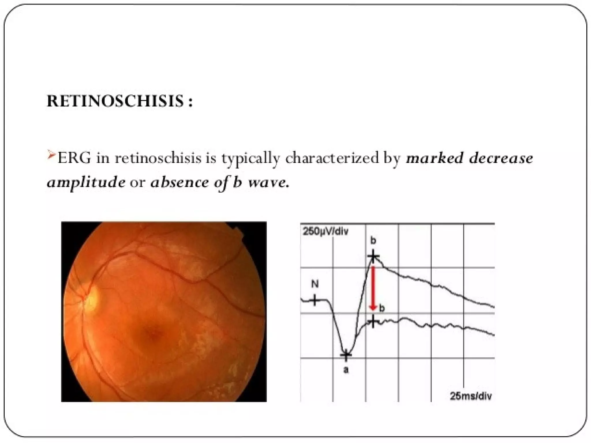 Retinoschisis | PPT