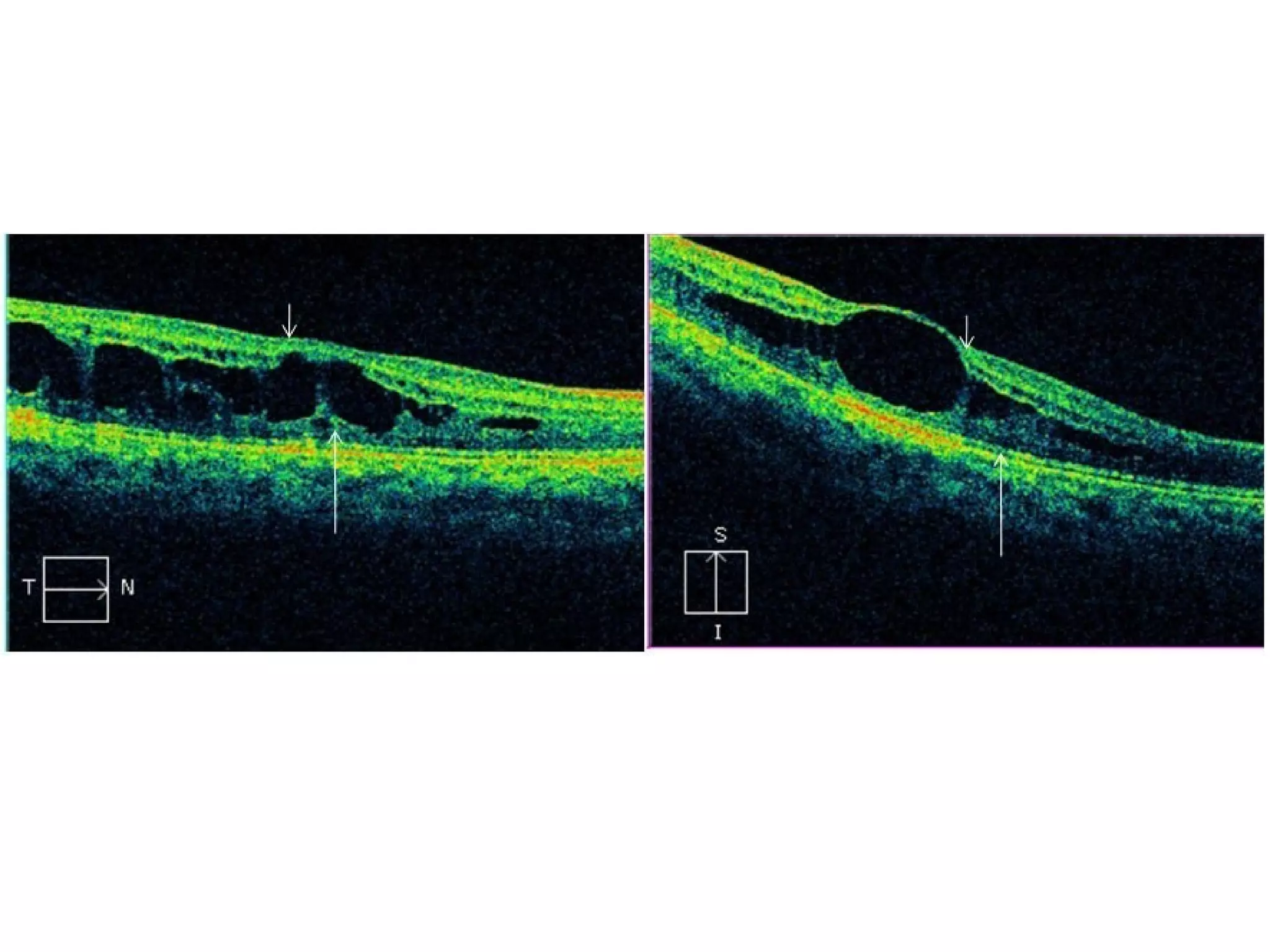 Retinoschisis | PPT
