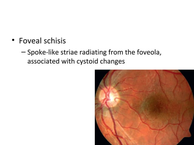 Retinoschisis | PPT
