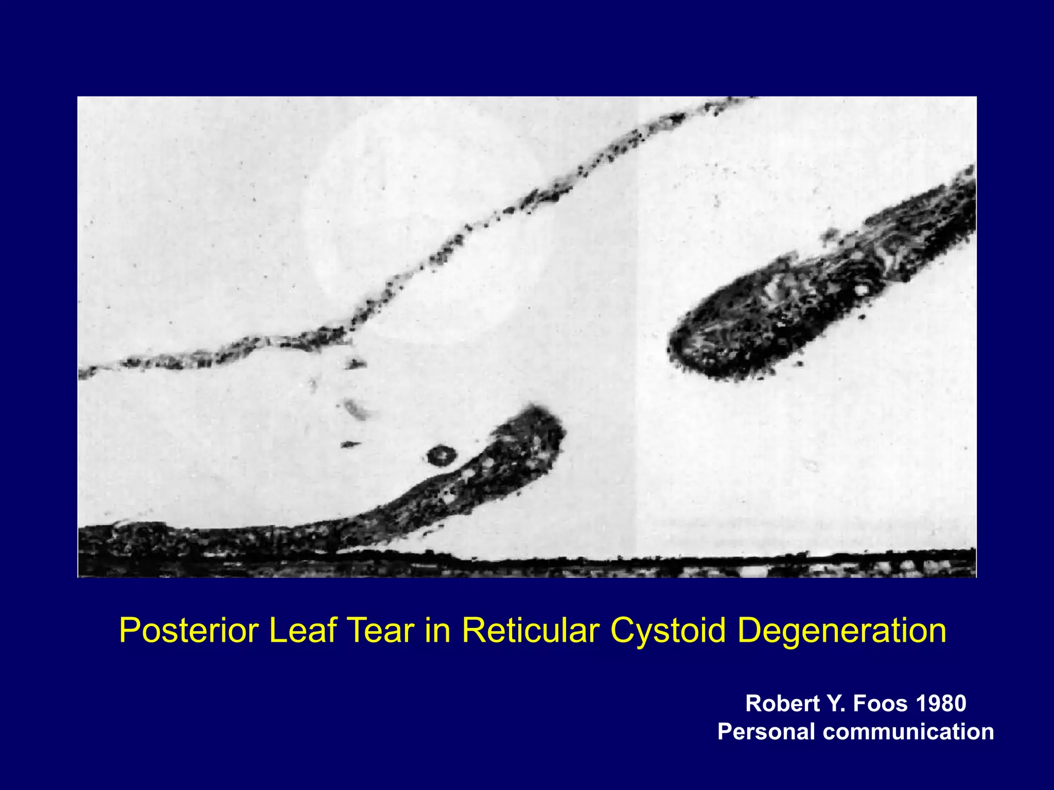 RETINOSCHISIS AND RETINAL DETACHMENT | PPT