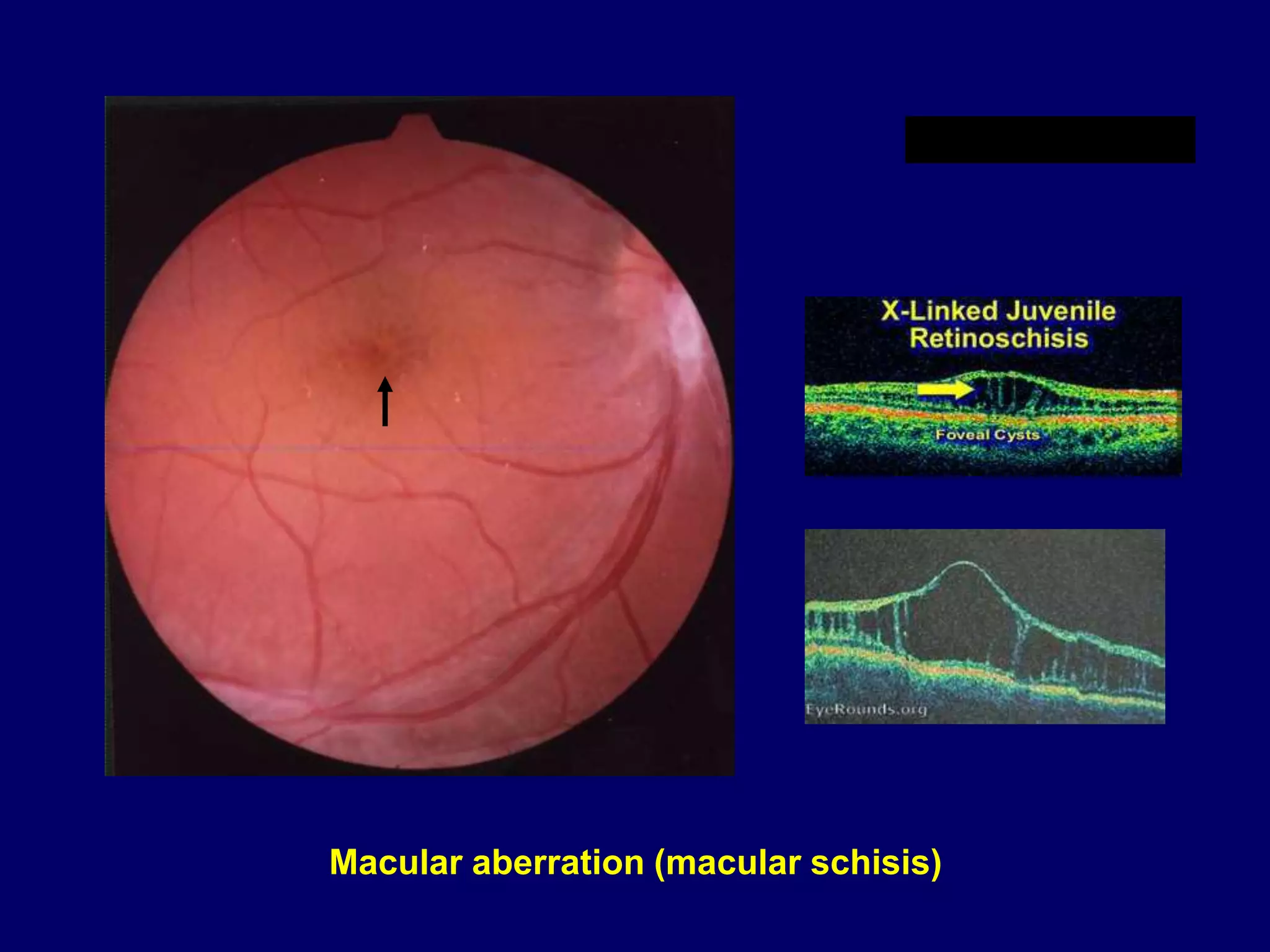 RETINOSCHISIS AND RETINAL DETACHMENT | PPT