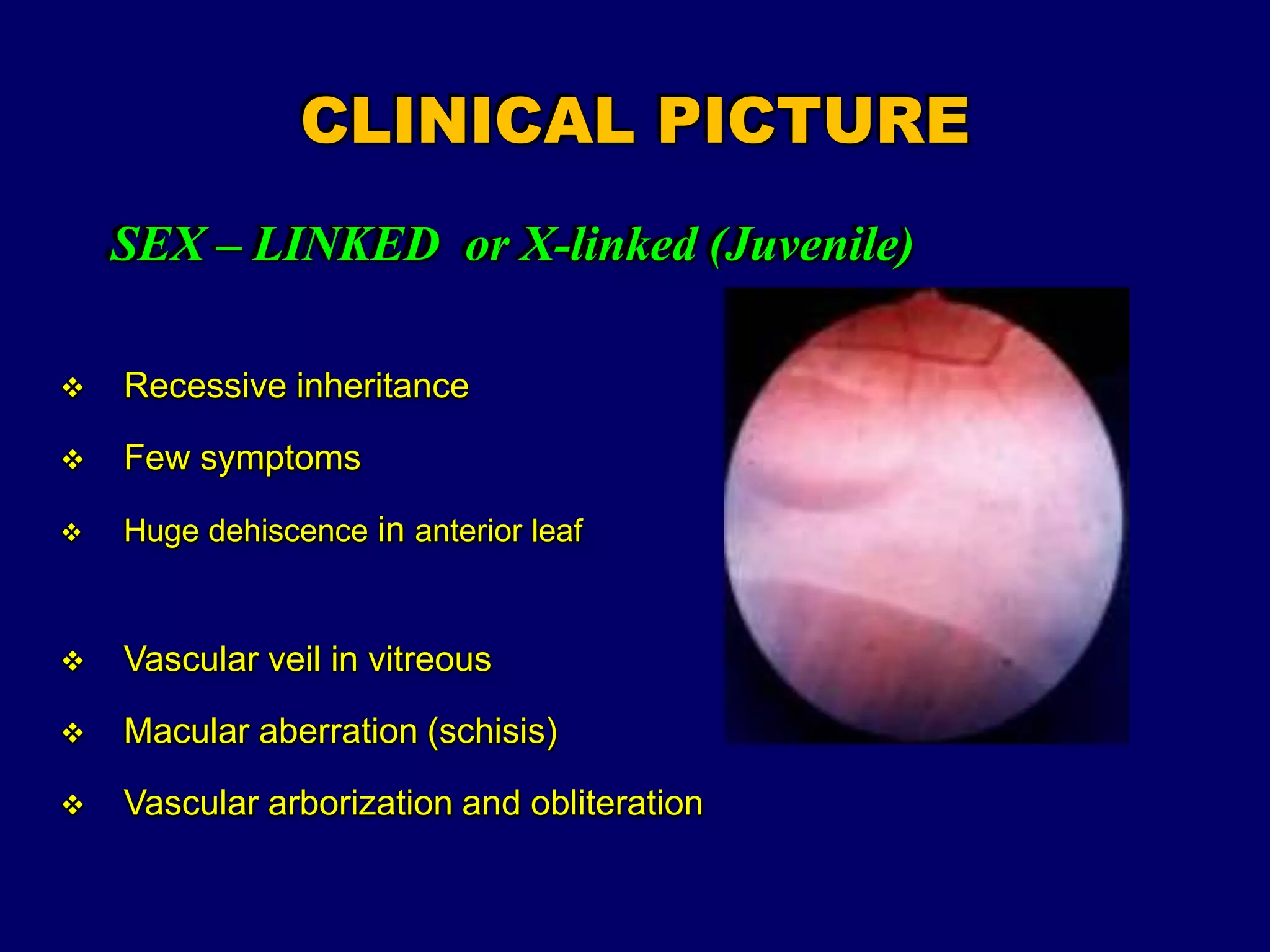 RETINOSCHISIS AND RETINAL DETACHMENT | PPT