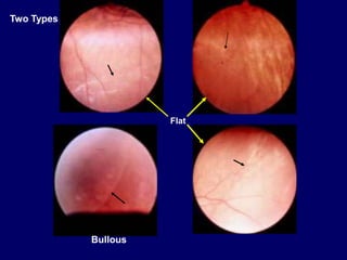 RETINOSCHISIS AND RETINAL DETACHMENT | PPT