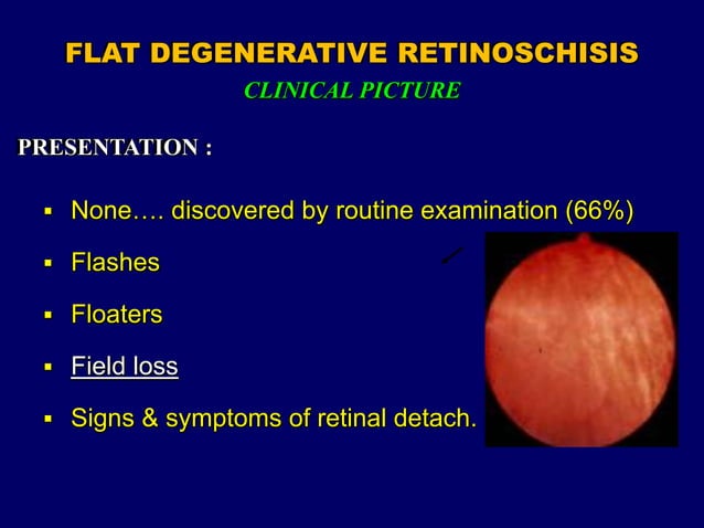 RETINOSCHISIS AND RETINAL DETACHMENT | PPT | Eye and Vision Conditions ...